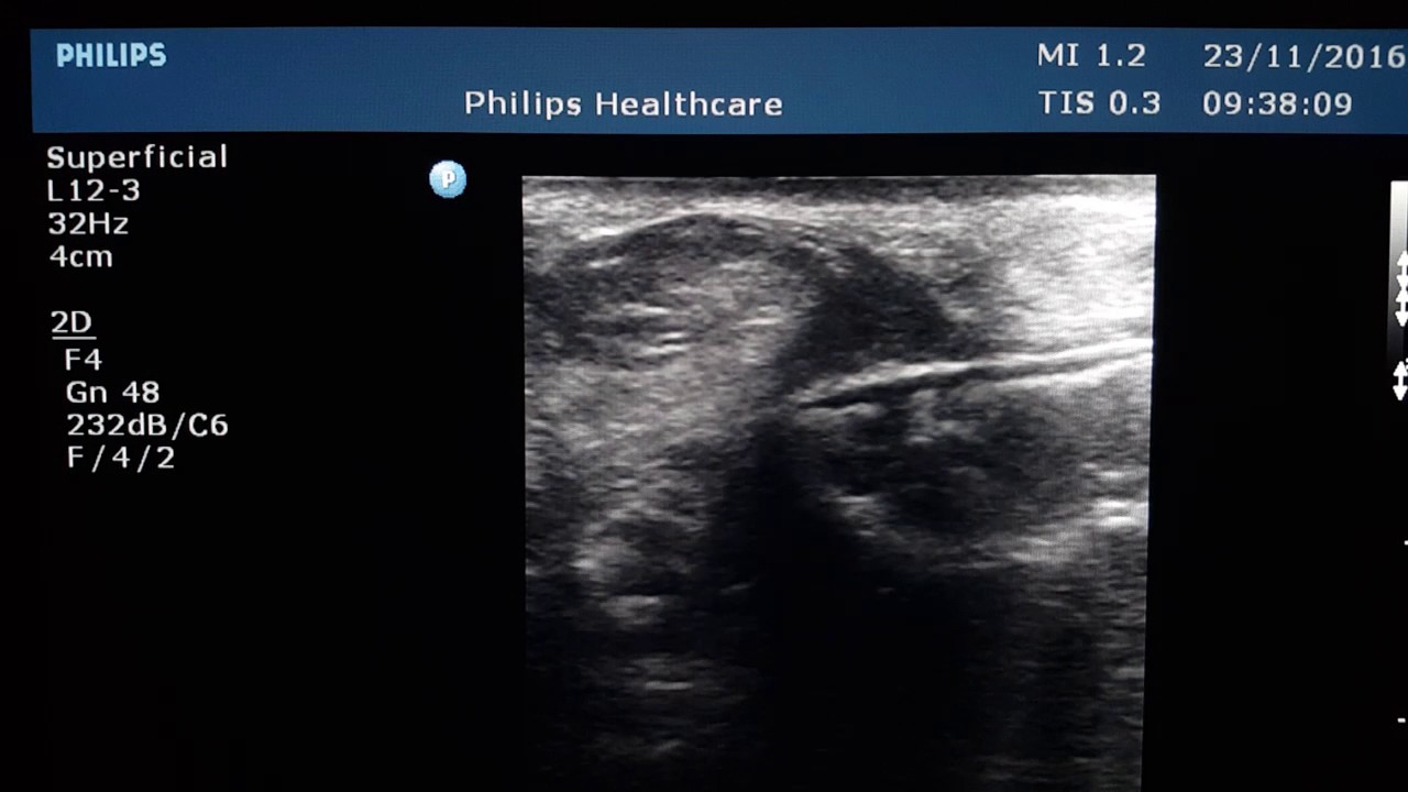 Supra Umbilical Hernia Ultrasound - YouTube