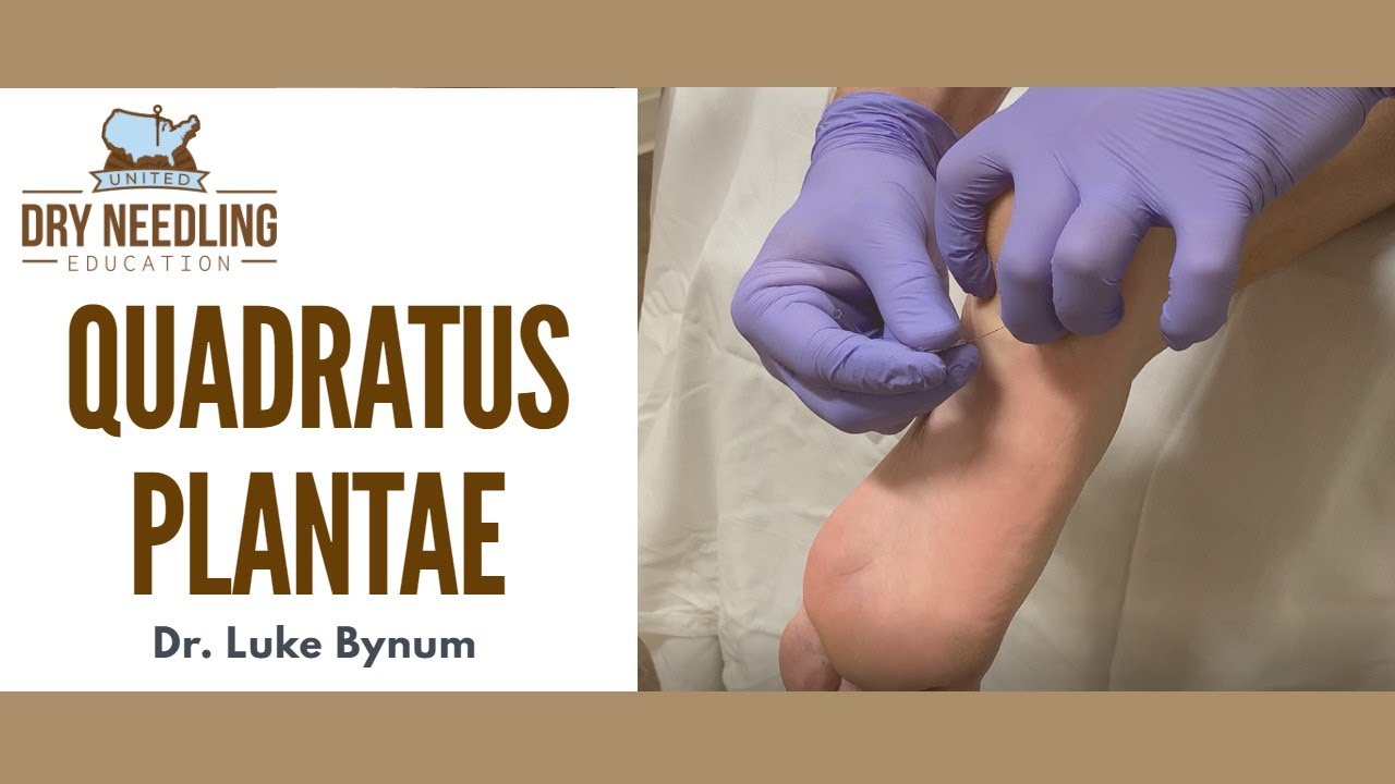 Dry Needling Quadratus Plantae - YouTube