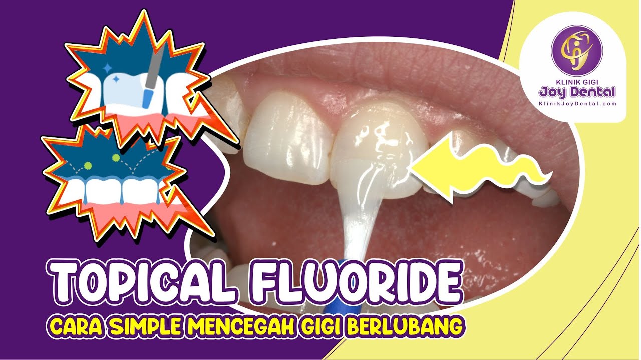TOPICAL FLUORIDE CARA PALING SIMPLE MENCEGAH GIGI BERLUBANG - YouTube