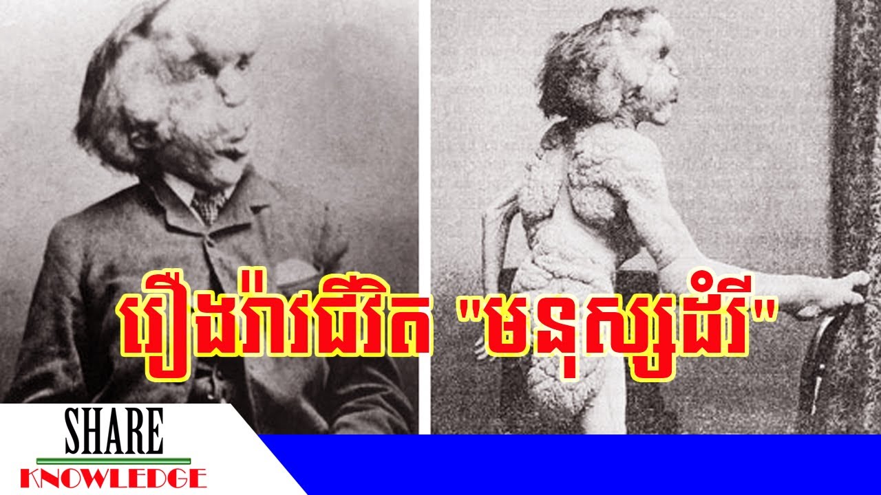 រឿងរ៉ាវរបស់មនុស្សដំរី Joseph Carey Merrick - YouTube