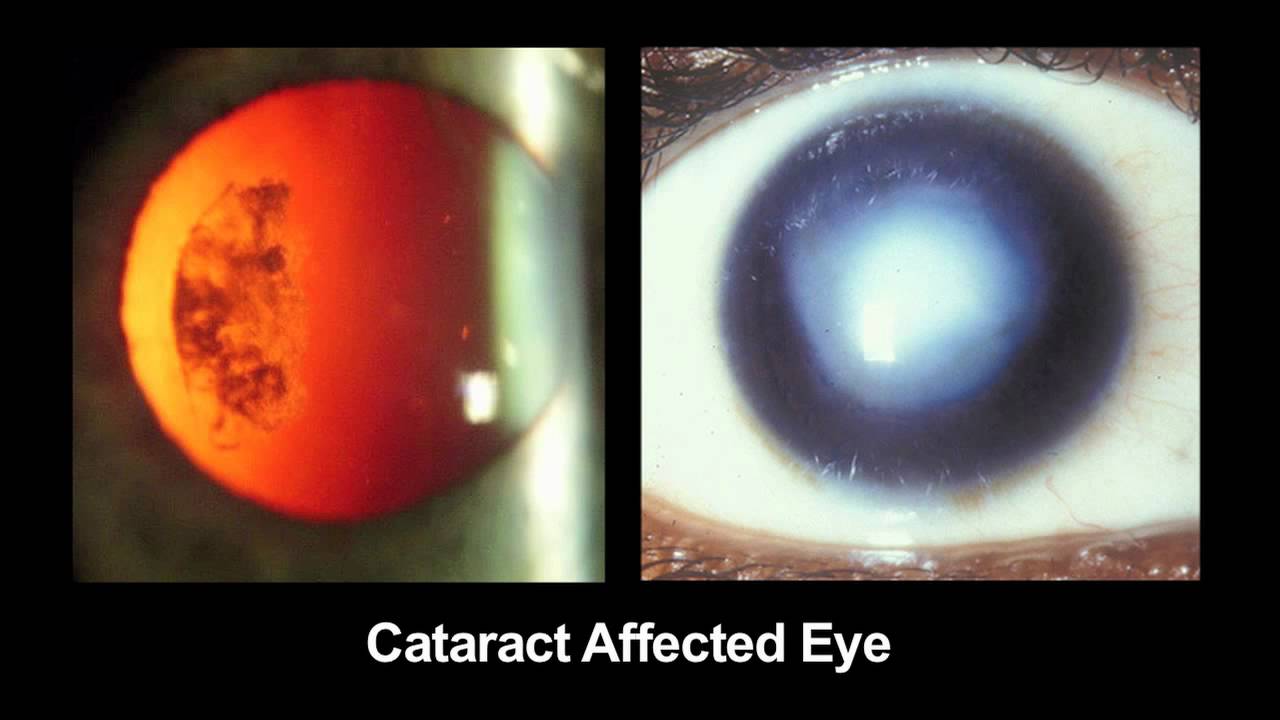CATRA: Cataract Maps with Snap-on Eyepiece for Mobile Phones - YouTube