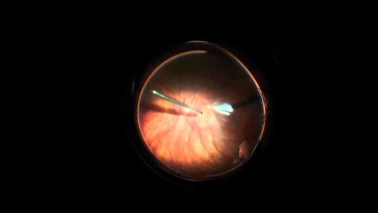 ILM Flap (Agujero Macular miope con foveosquisis / Vitrectomía y flap ...