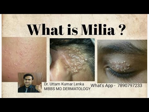 Cause and treatment of milia? White colour bumps/white head on face ...