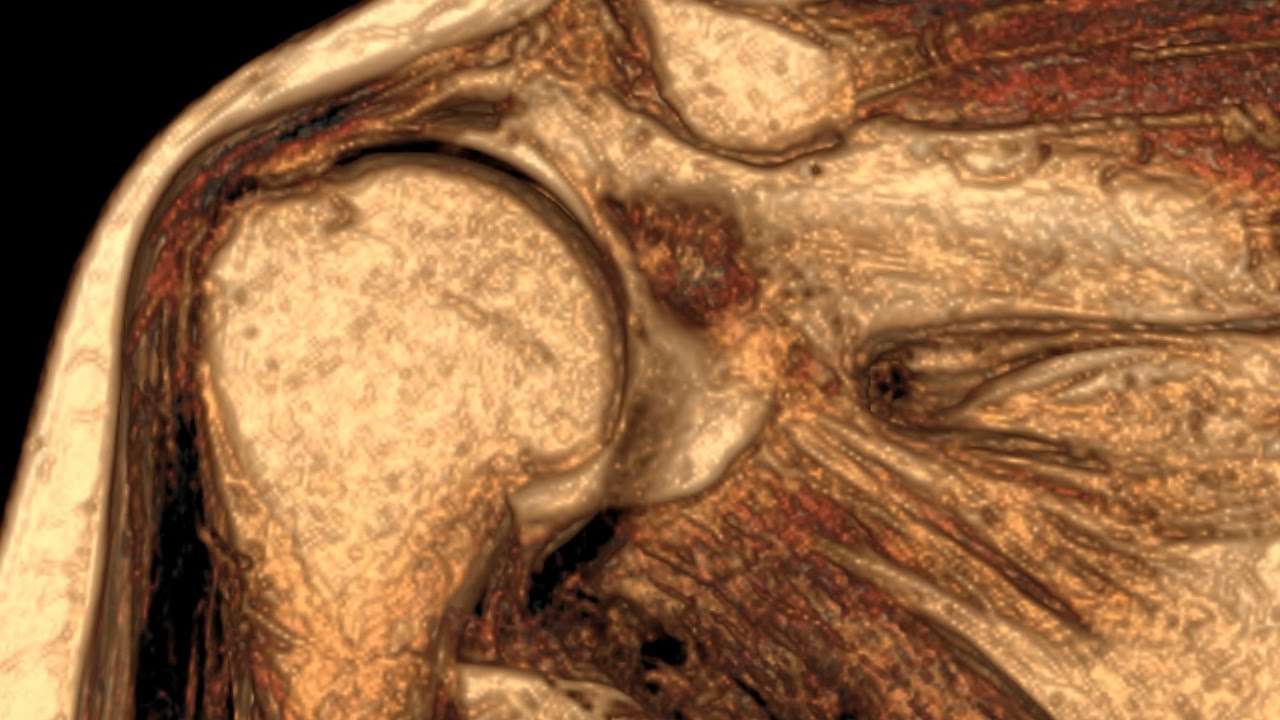 Massive rotator cuff tear with humeral head upward migration - YouTube