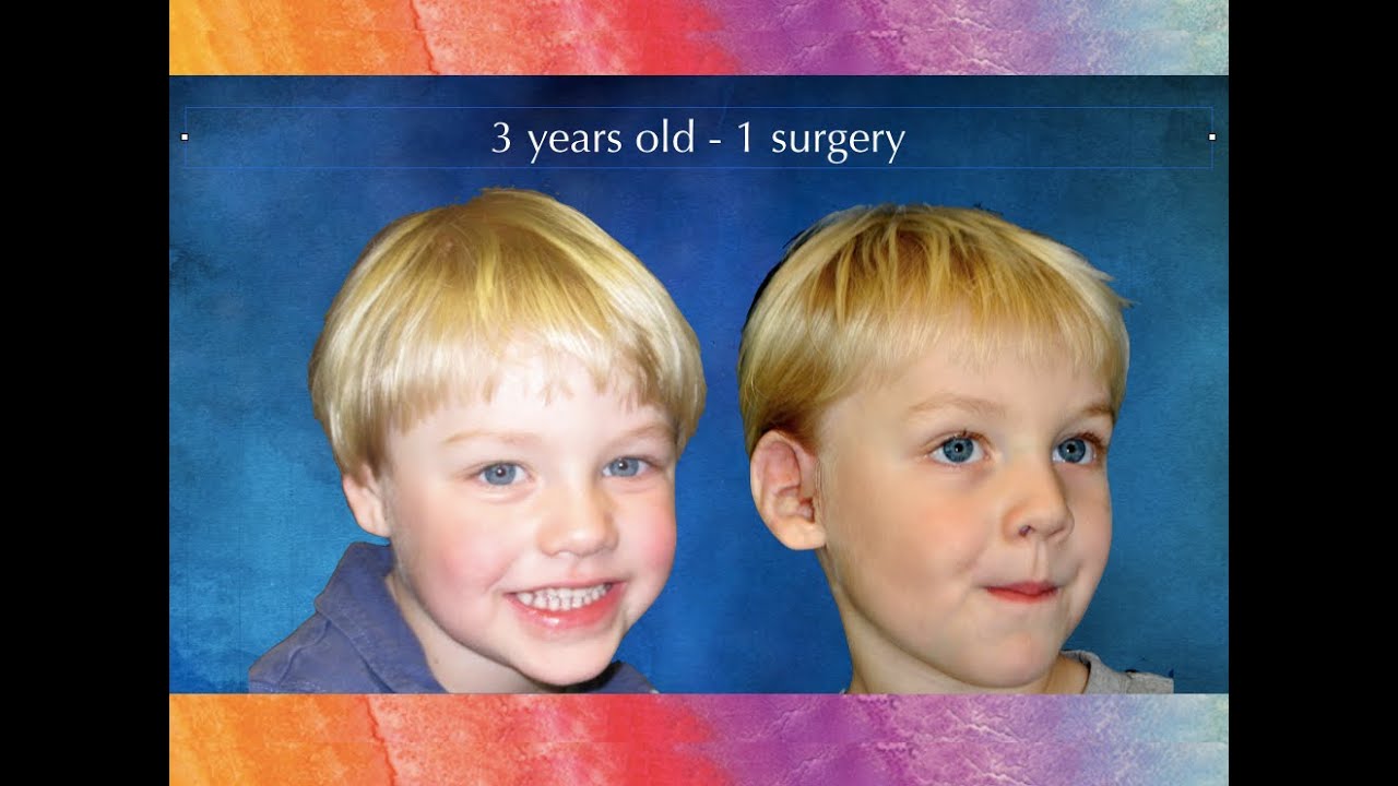 Dr. Lewin's Porous Implant Ear Reconstruction (Medpor/Su-Por) Lecture ...