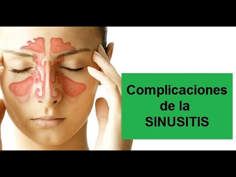 🔴 COMPLICACIONES DE UNA SINUSITIS BACTERIANA - YouTube