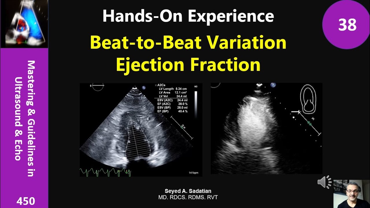 Hands-On Experience 38: Beat-to-Beat Variation & Ejection Fraction ...