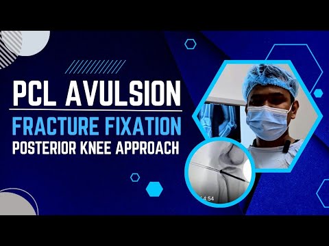 PCL Avulsion Fracture Fixation | doctorrafi - YouTube