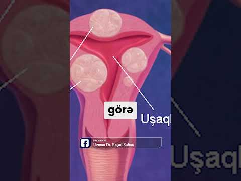 Mioma (uşaqlıq şişi) - Böyüdükcə hansı problemlərə səbəb olur?