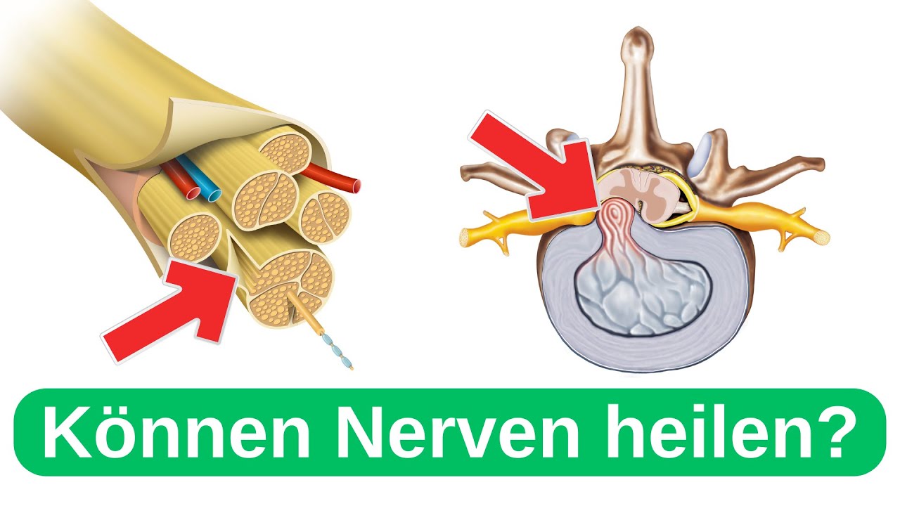 Bandscheibenvorfall Lws Lendenwirbelsäule Können Nerven Heilen Youtube