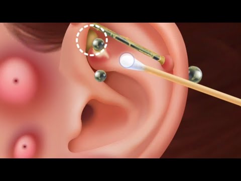 ASMR removing Ear infection ||| How to remove Ear infection ||| ASMR ...