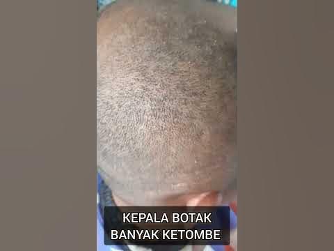 Rambut sudah botak tapi banyak Ketombe | apakah harus diBotakin terus seperti ini ? - YouTube