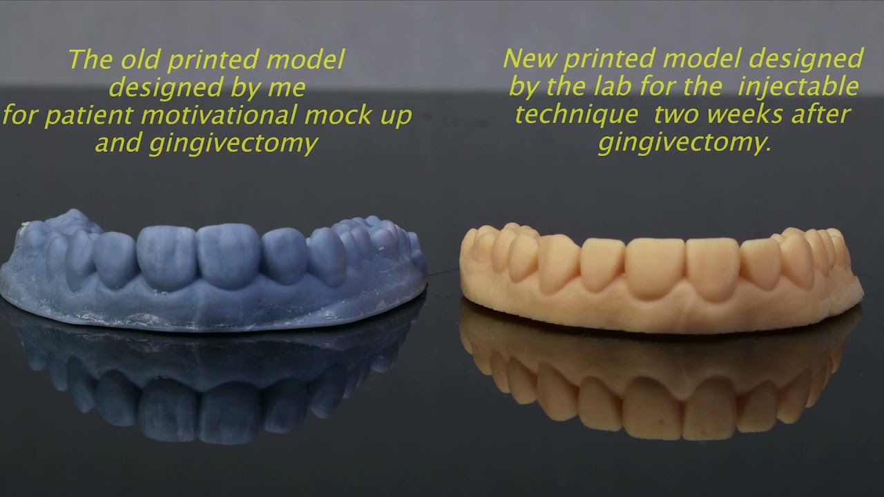 Injectable composite technique.A transitional procedure for full mouth ...