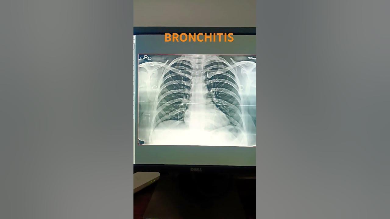 X ray chest PA broncho vascular marking are prominent in both lungs ...