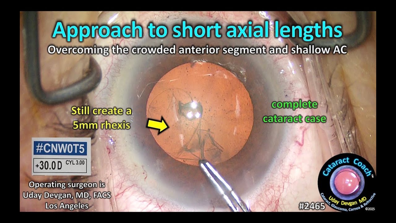 CataractCoach™ 2465: Approach to short axial lengths in cataract surgery - YouTube