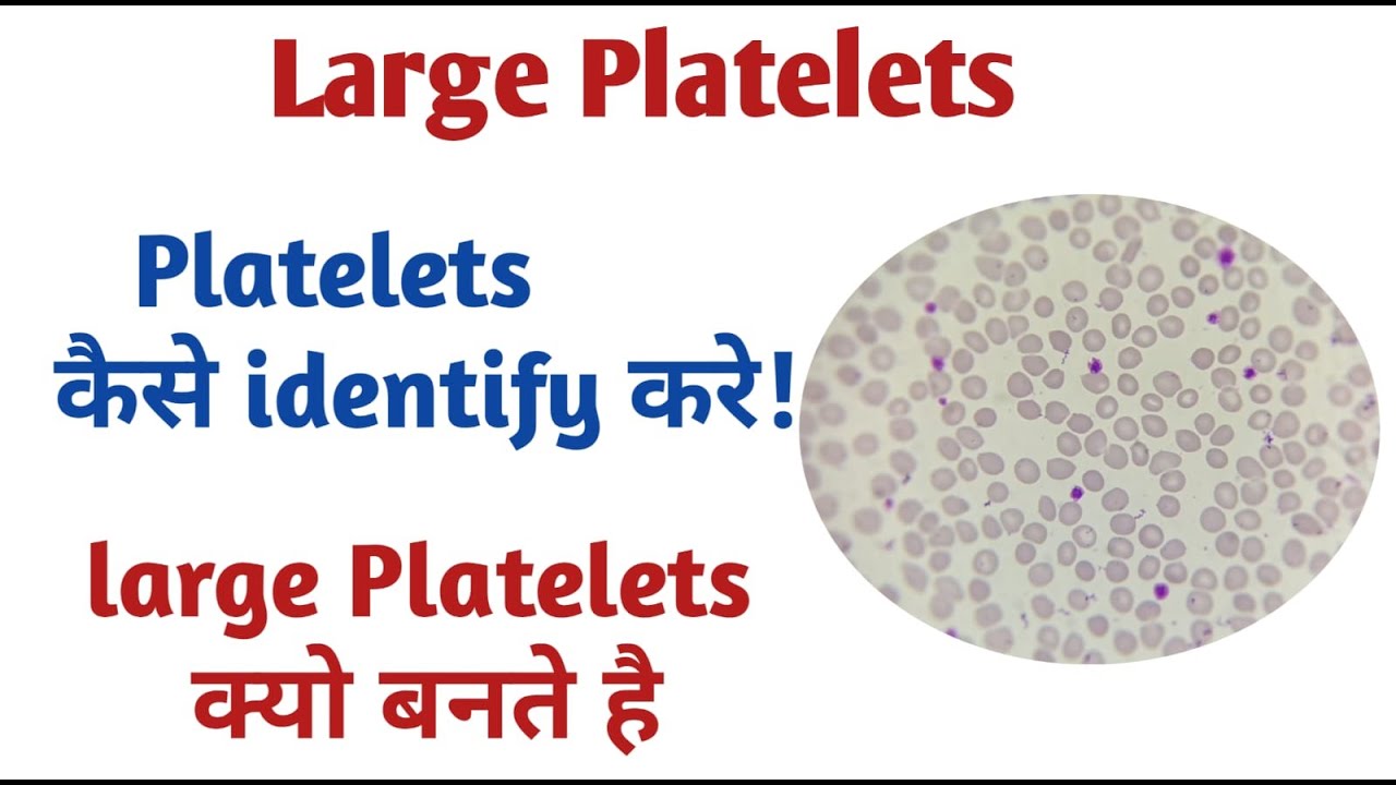 Large platelets seen I Large platelets size - YouTube