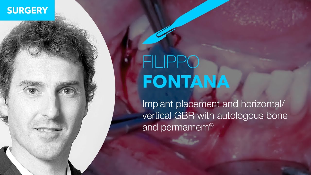 Implant placement and horizontal/vertical GBR with autologous bone and ...
