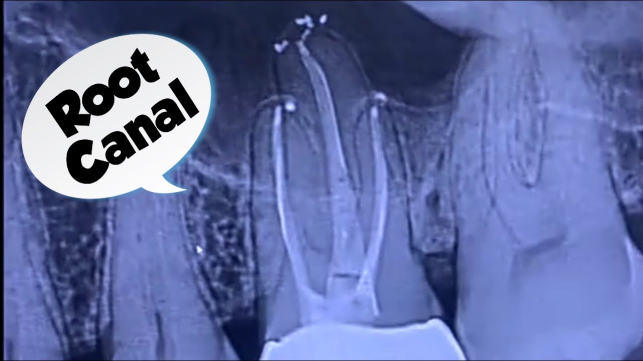 Endodontic re treatment of tooth numbr 14 / Root Canal - YouTube
