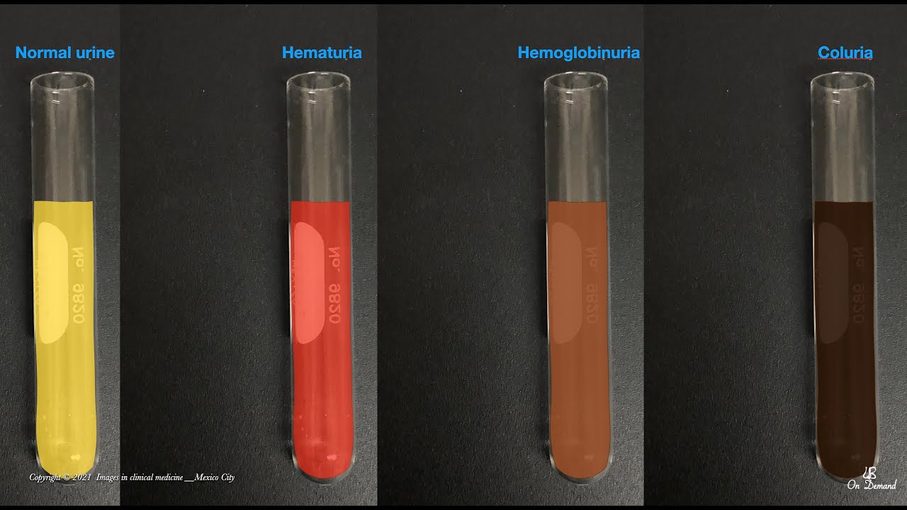 Hematuria, Hemoglobinuria, Hemosiderinuria and Coluria - YouTube