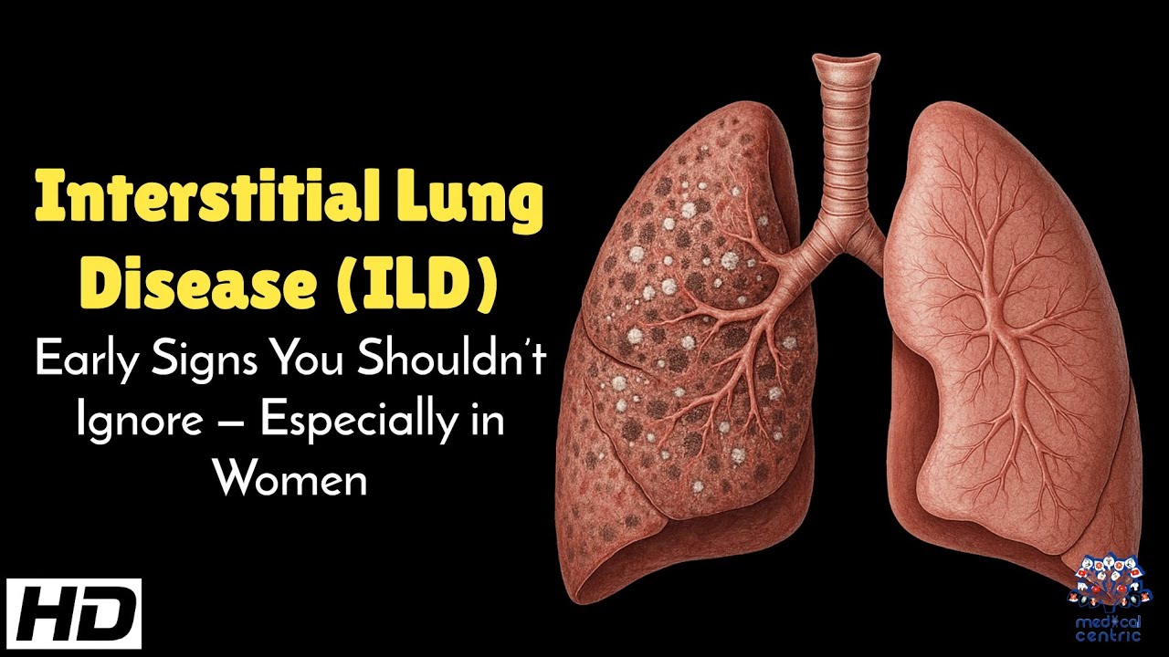 Interstitial Lung Disease (ILD) Early Signs You Shouldn’t Ignore ...