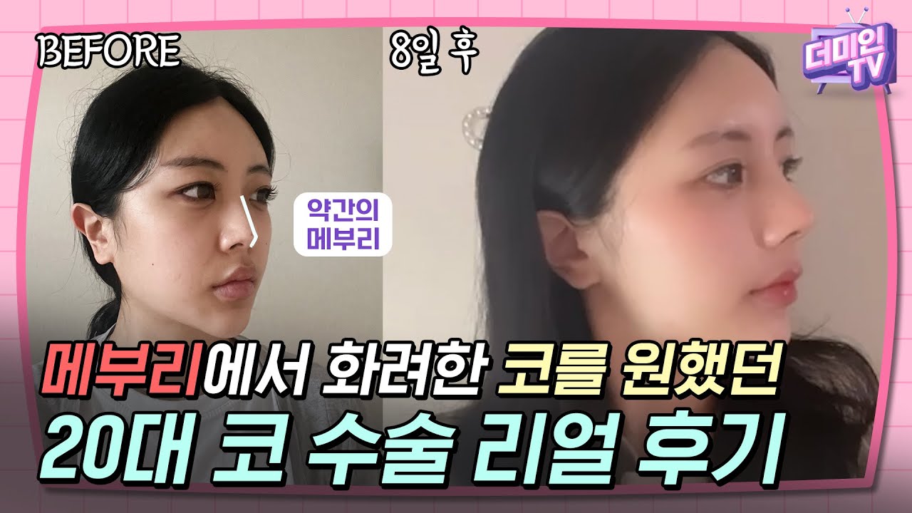 코성형 한번에 옆태미인으로 20대 무보형물 코성형 상담부터 수술까지 스토리 공개합니다 Youtube