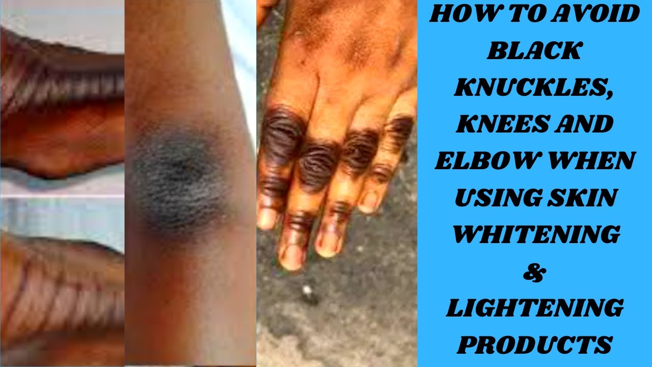 HOW TO AVOID DARK KNUCKLES, ELBOWS, AND KNEES WHEN USING SKIN ...