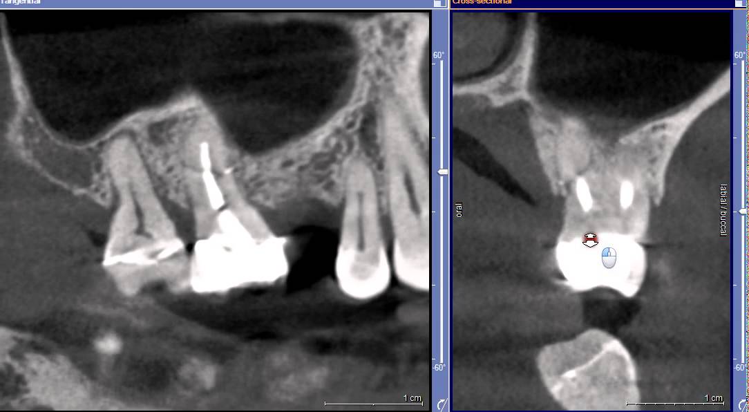 Fractured Root YouTube fractured-root-youtube