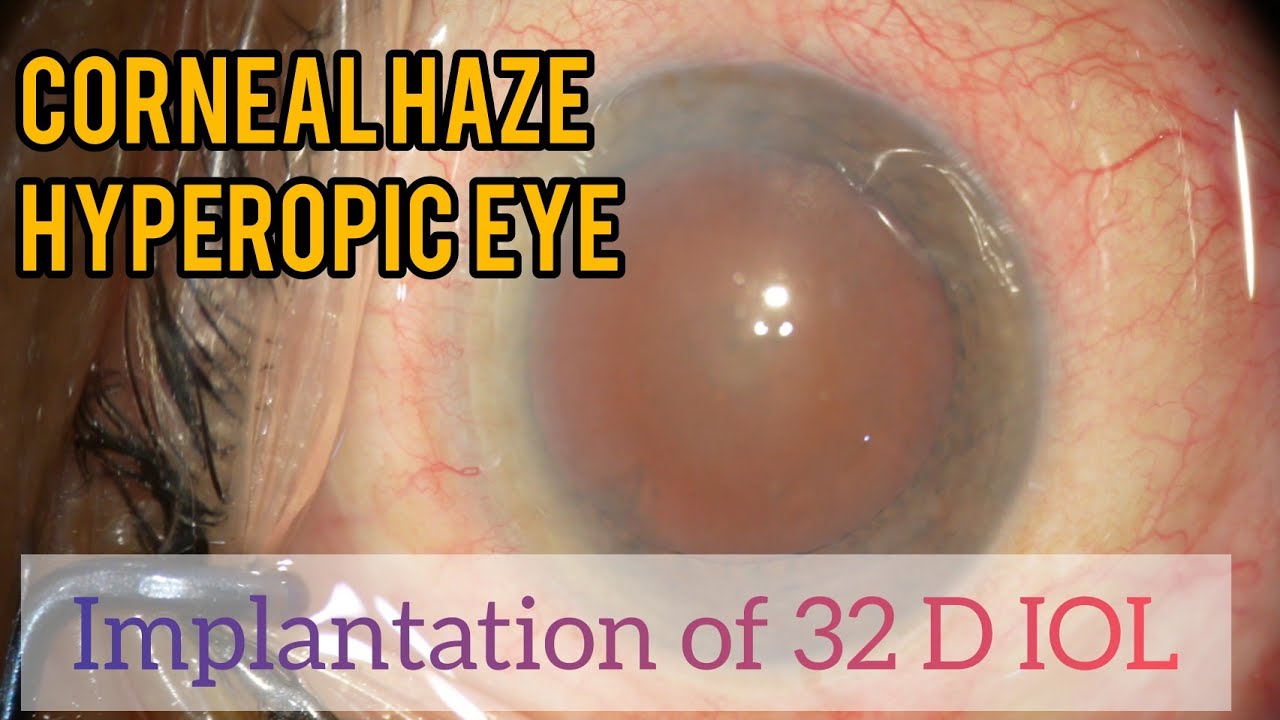 Phacoemulsification in a corneal haze and hyperopic eye with ...