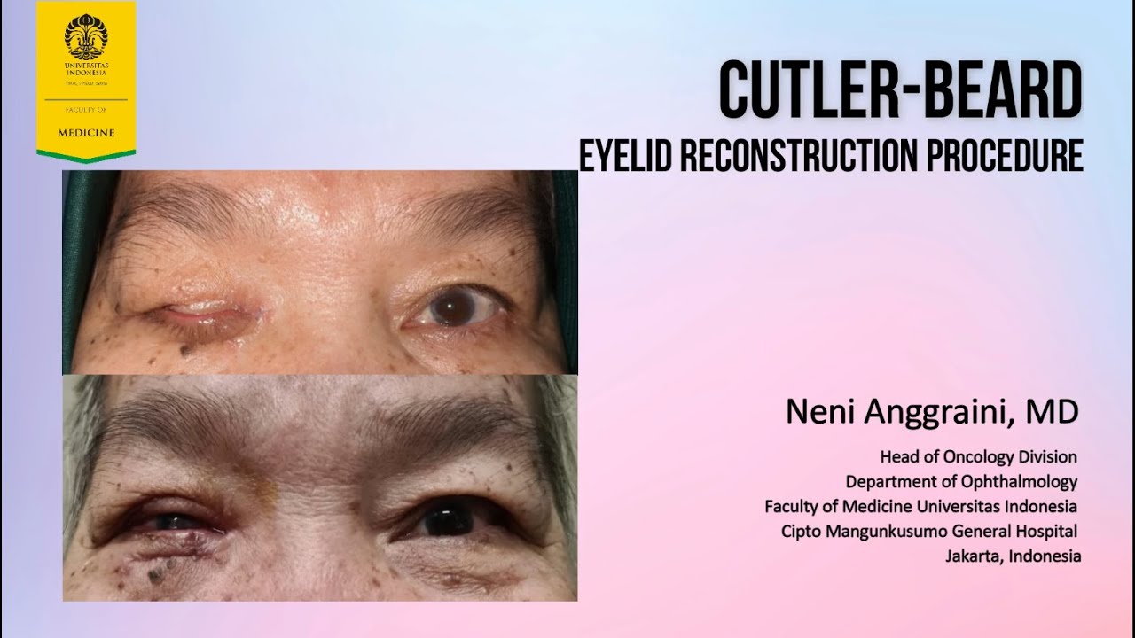 Cutler-Beard Eyelid Reconstruction Procedure - YouTube