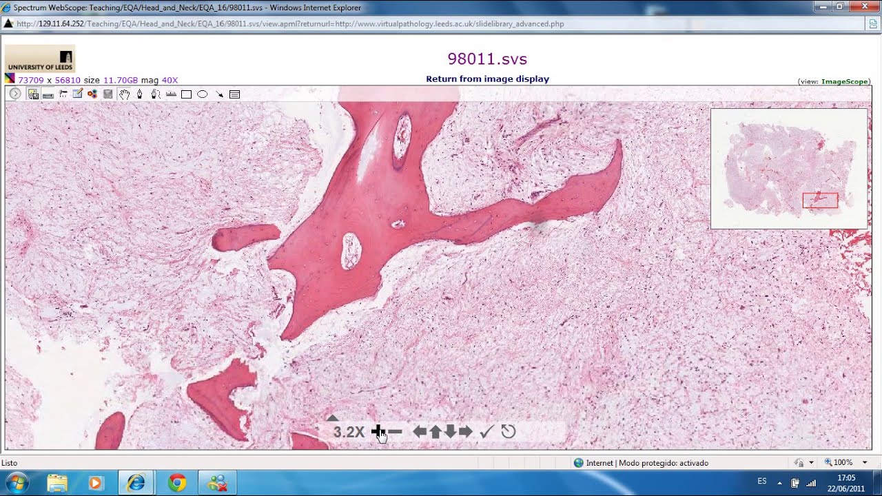 Odontogenic Myxoma. Mixoma Odontogénico.🔬#odontogenictumors #Myxoma ...