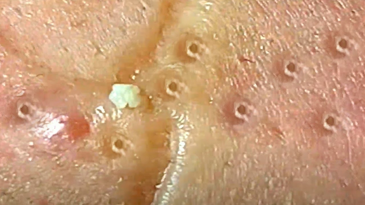 Big Cystic Acne Blackhead, Extraction Blackheads & Milia #237 ...