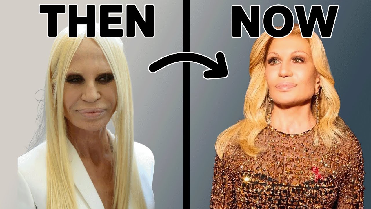 Donatella Versace's Transformation | - A Cosmetic Doctor's Expert ...
