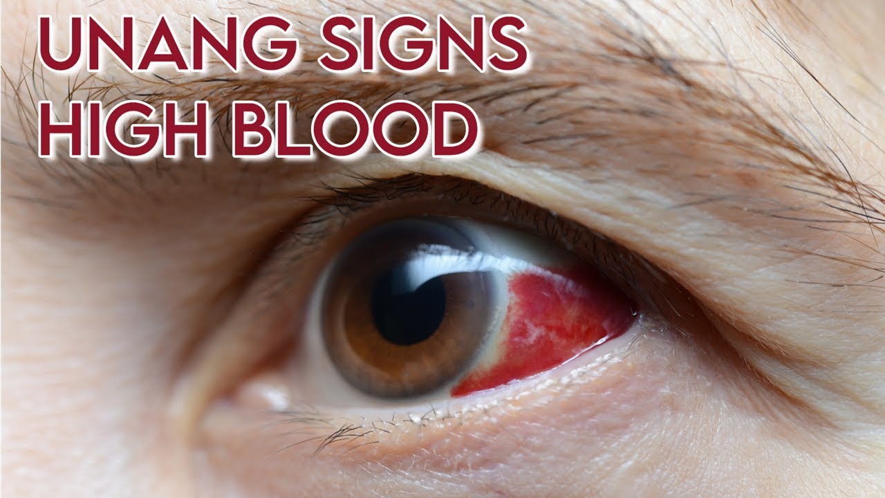 Unang Warning Signs ng High Blood pressure o Altapresyon o Hypertension ...