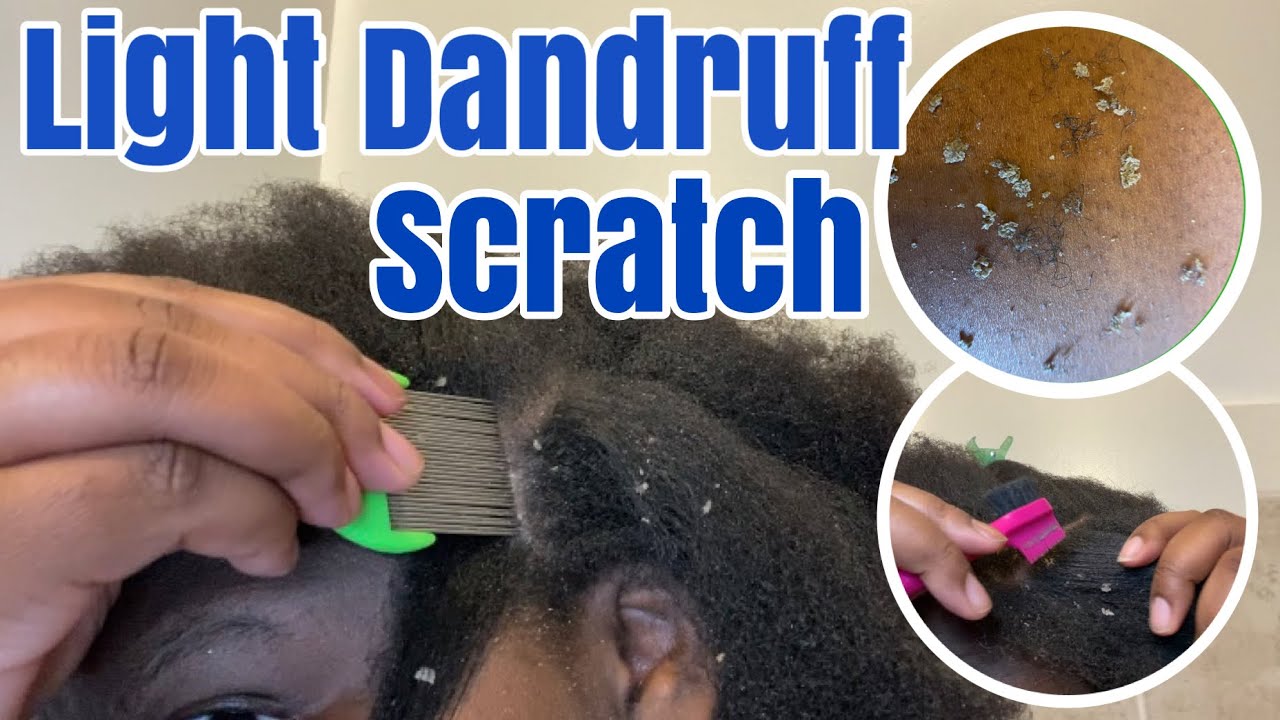 STUBBORN FLAKES | LIGHT DANDRUFF SCRATCH - YouTube