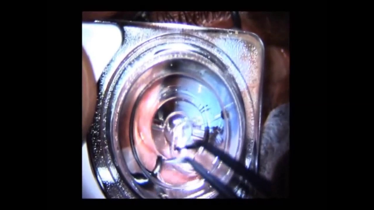 Femtolaser assisted Kera rings ICRS implantation Amr Fawzy, MD, FRCS(Ed ...