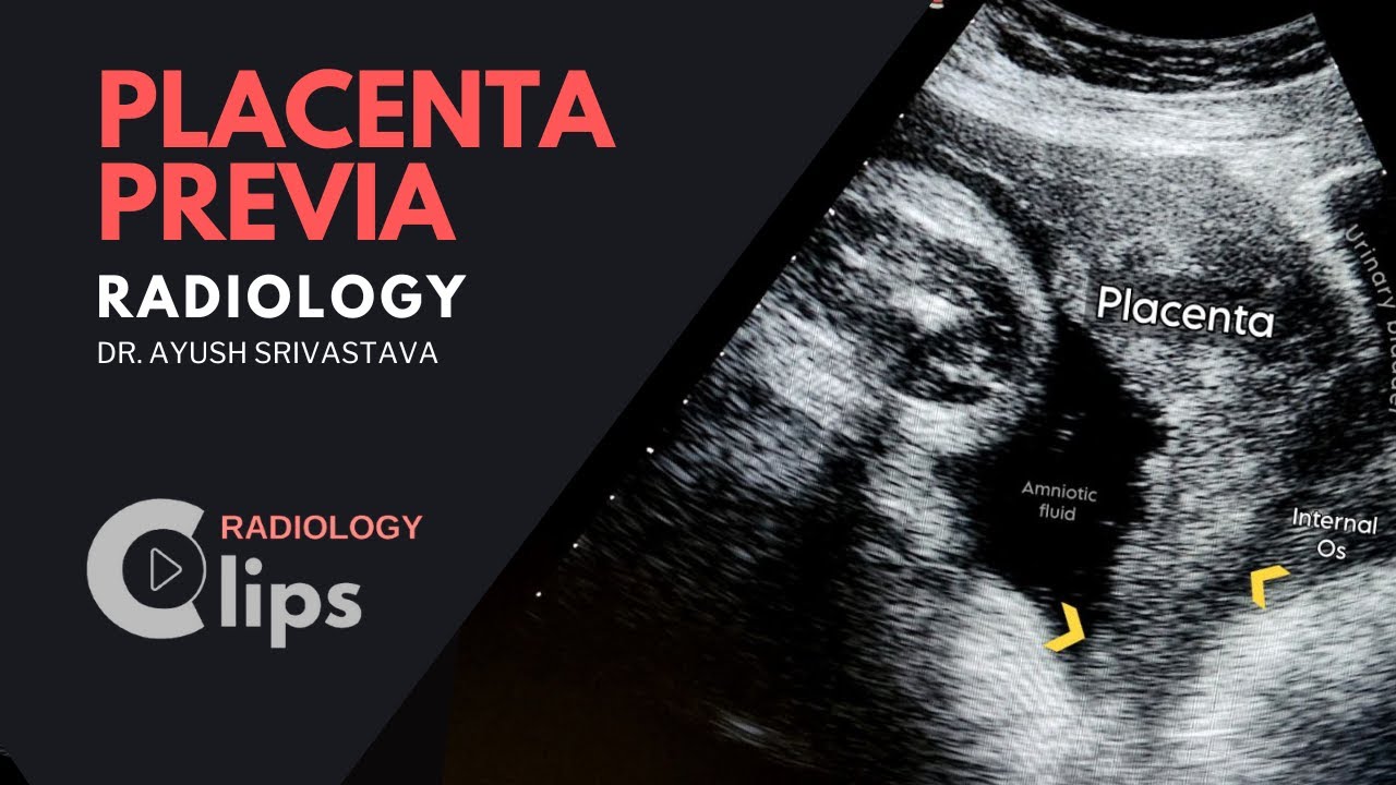 Placenta previa: Everything you need to know | Obstetric Ultrasound ...