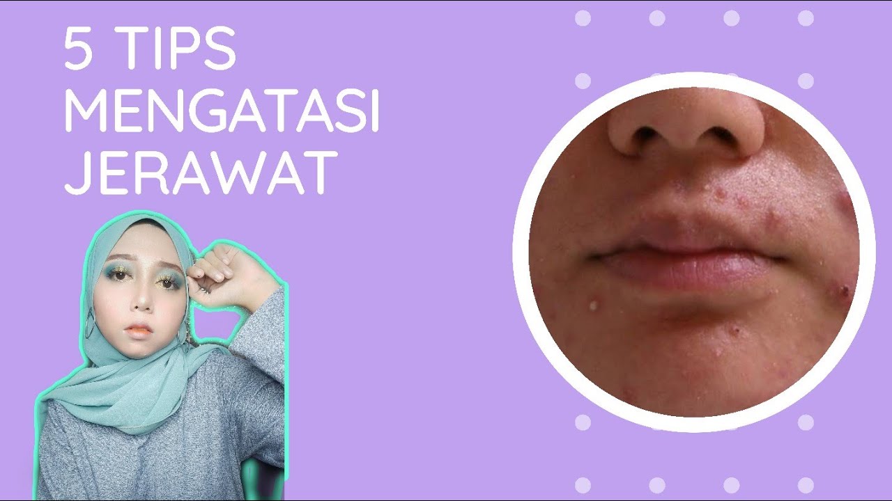 Tips Mengatasi Jerawat - YouTube