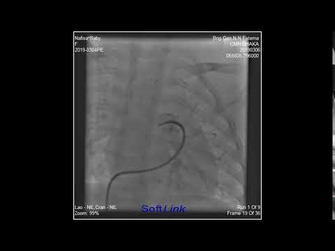 Baby Nafisa 1 6 Yrs 10 Kg Small PDA Aortogram AP Angio Show RFV ...