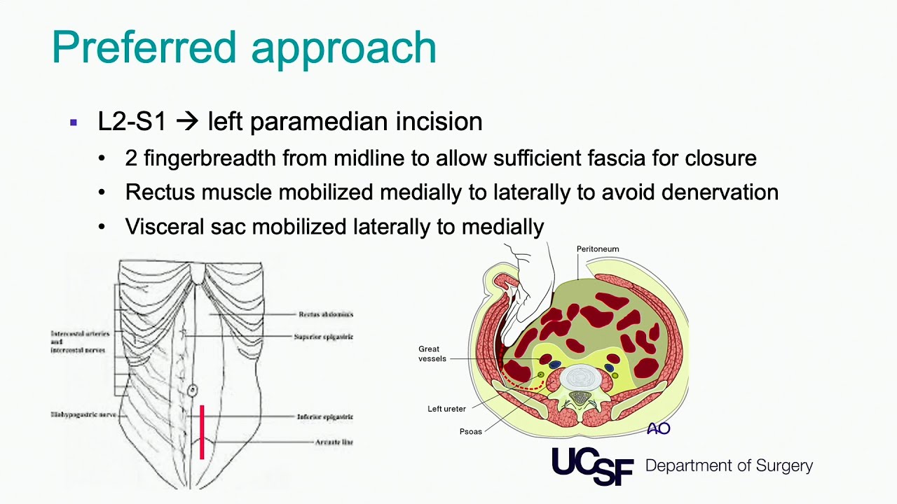 Retroperitoneal Access in Patients with Prior Abdominal Operations ...
