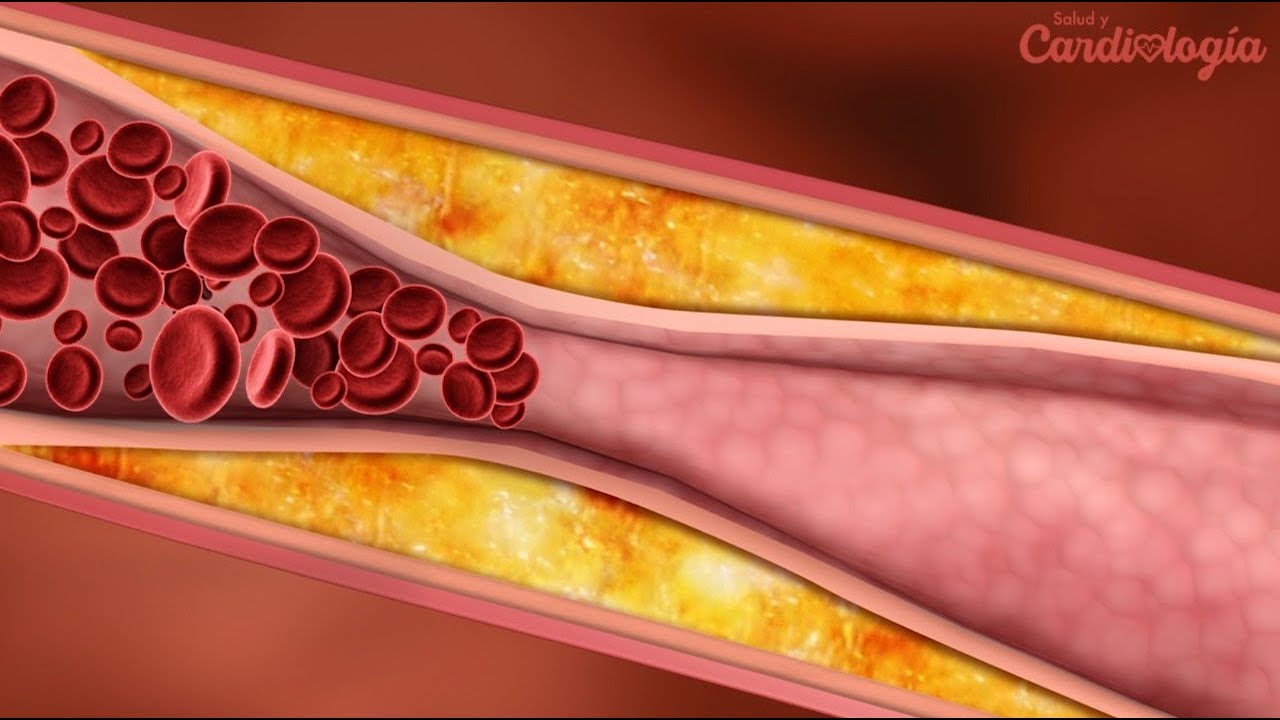 Funcionamiento Y Obstrucción De Las Arterias Del Corazón Youtube