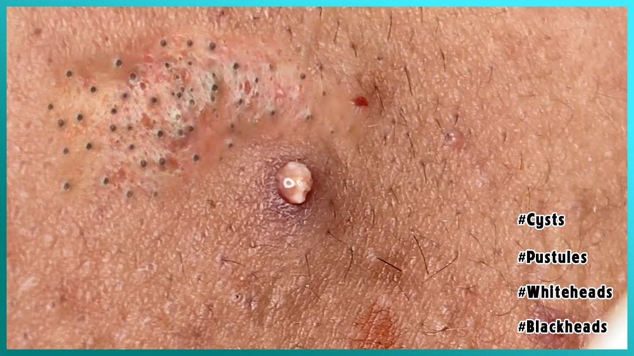 Youtube Pimples And Blackheads 0058