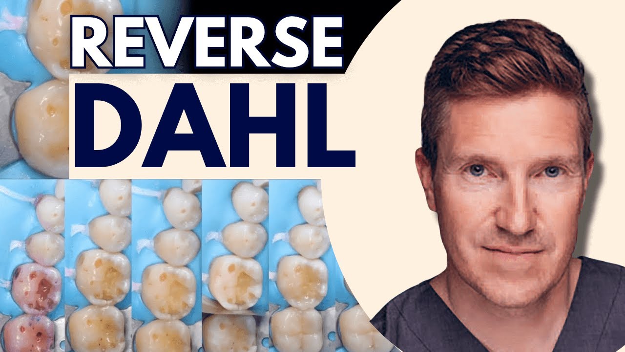 Reverse Dahl Technique for Localised Posterior Tooth Surface Loss ...