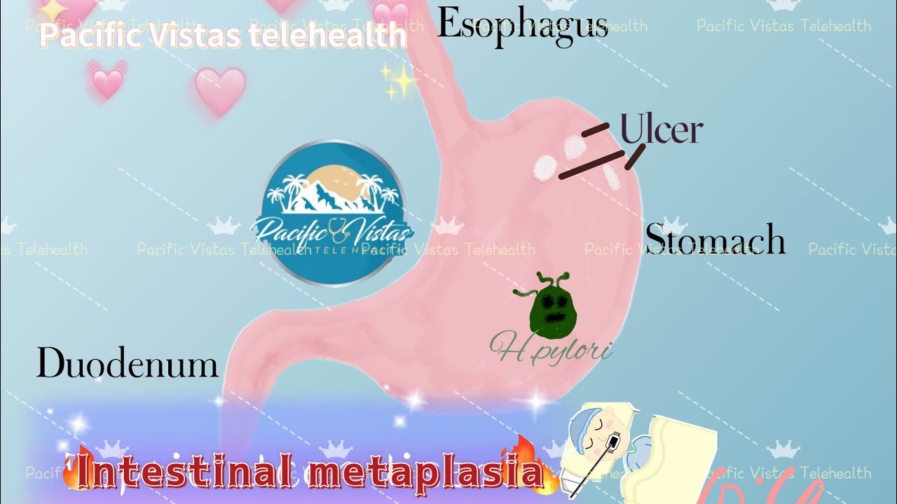 Intestinal metaplasia, gastric cancer,intestine cell, stomach cancer ...