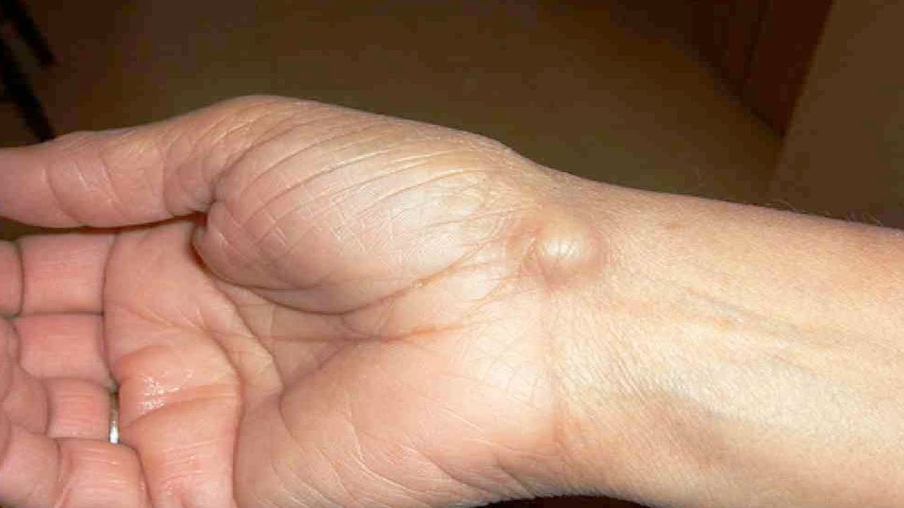 Home Remedies For Ganglion Cysts YouTube