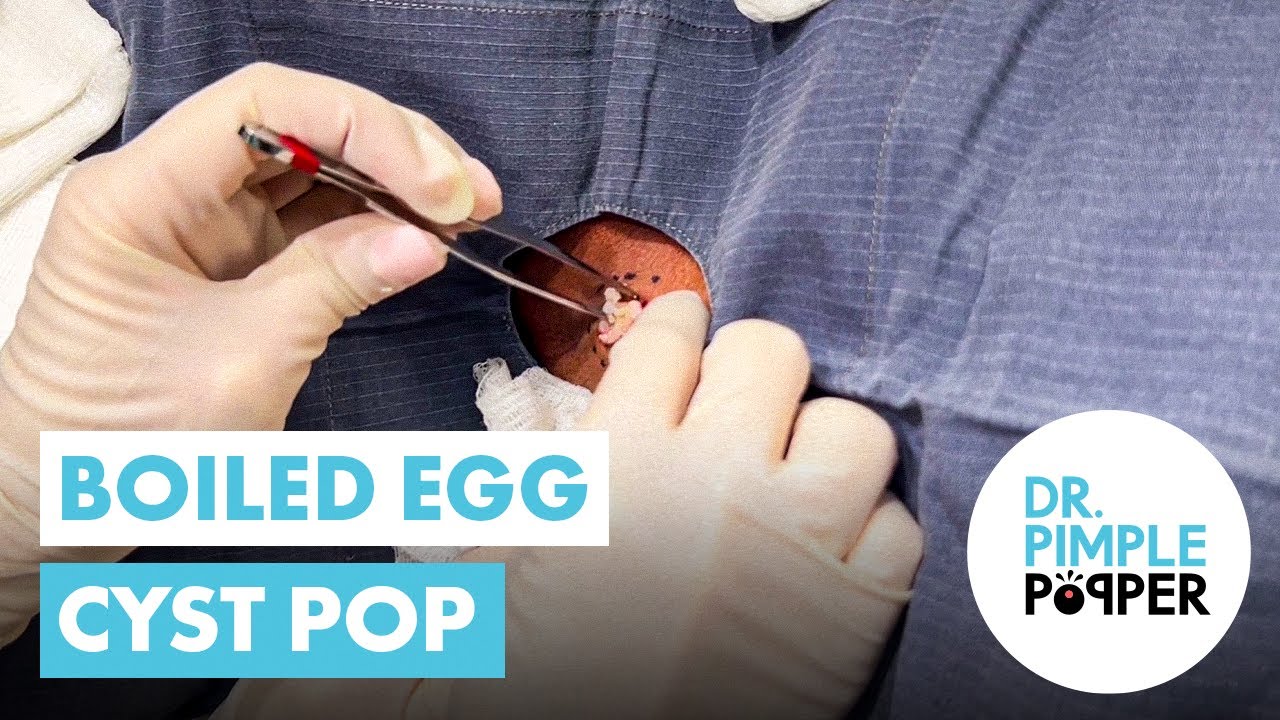 Boiled Egg Cyst Pop - YouTube
