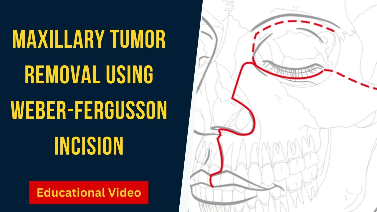 Maxillary Tumor Removal Using Weber-Fergusson Incision - YouTube