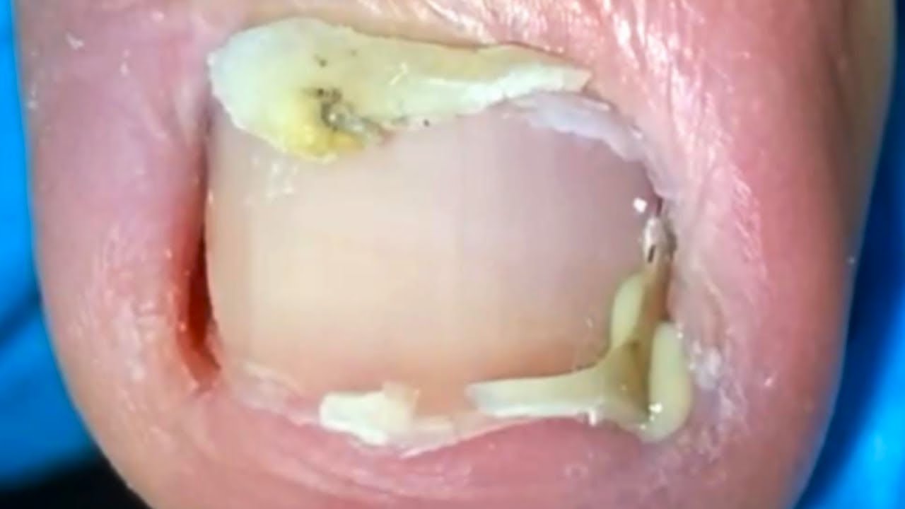 One Side Of The Ingrown Nail Is Inflamed, So I Pulled Out The Nail ...