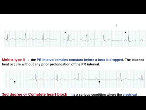 Different types of heart block, cardiology - YouTube