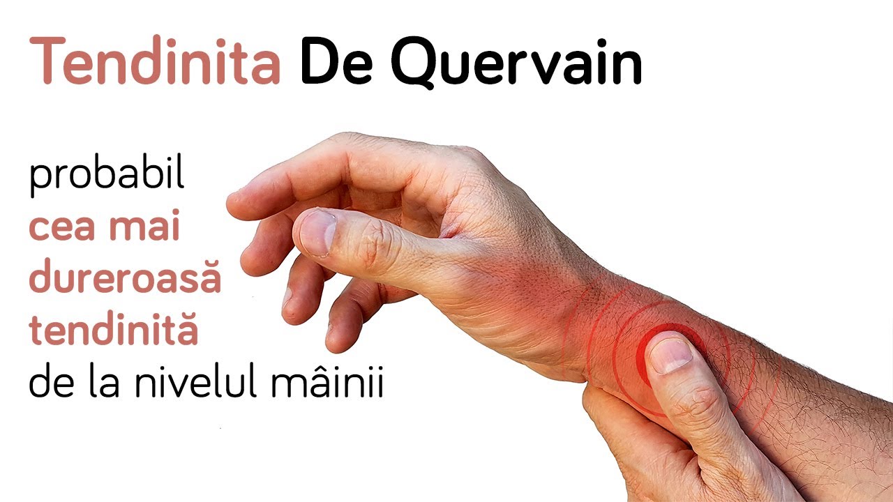 Tendinita De Quervain - tot ce trebuie să știi despre cea mai dureroasă ...
