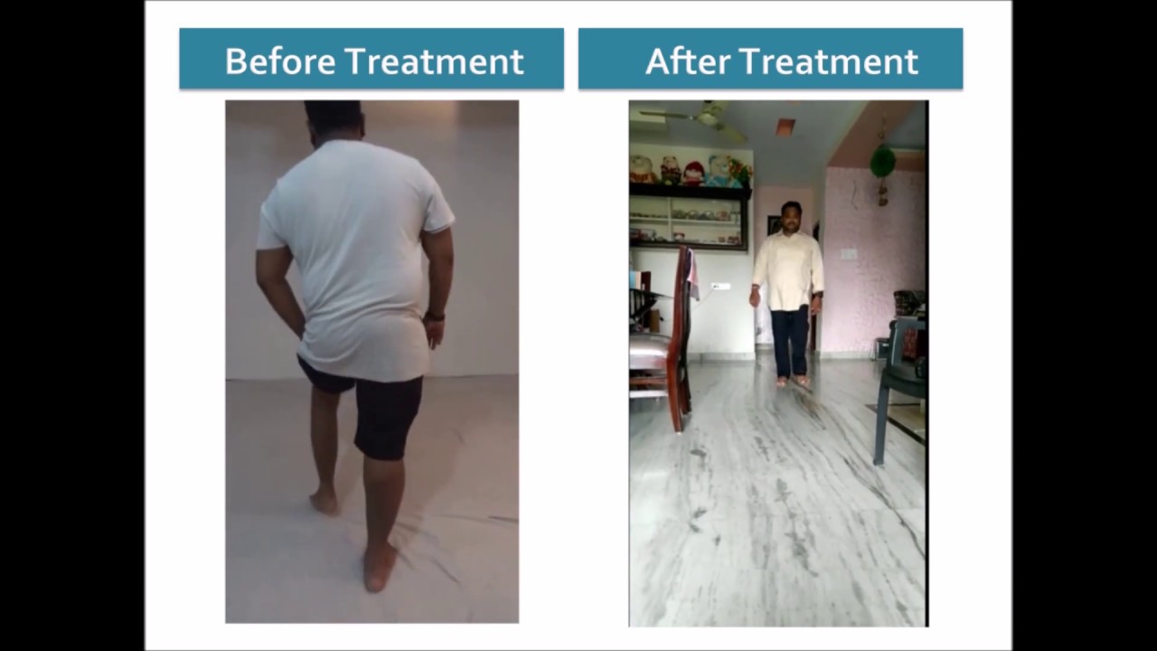 Hand Thigh Gait corrected in a patient of Polio with Ilizarov and ...